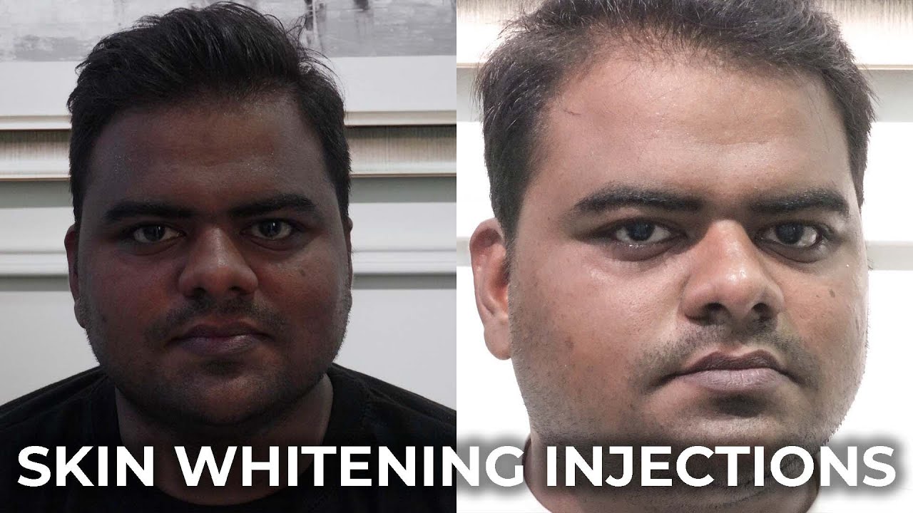 Safe WHITENING INJECTIONS in Karachi, Pakistan – Glutathione Benefits ...