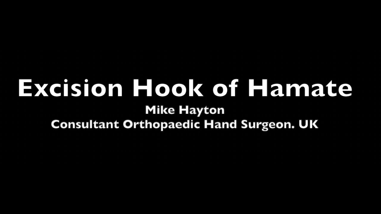Hook Hamate Excision - YouTube