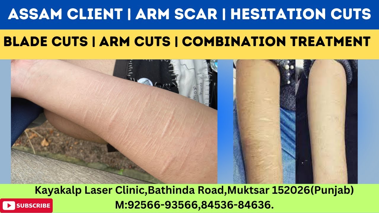 Assam Client | Arm Scar | Hesitation Cuts | Blade Cuts | Arm Cuts ...