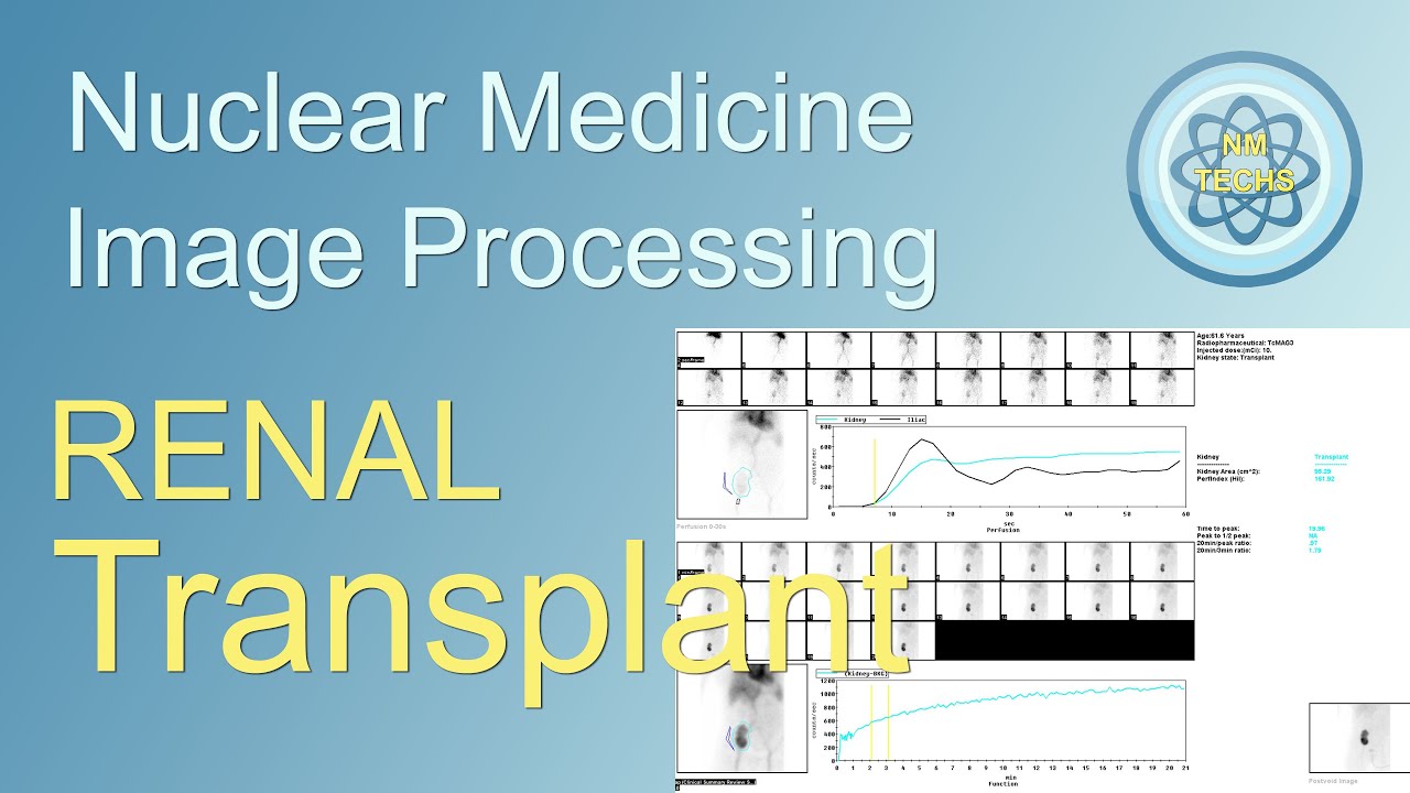 Renal Transplant image Processing, in nuclear medicine - YouTube