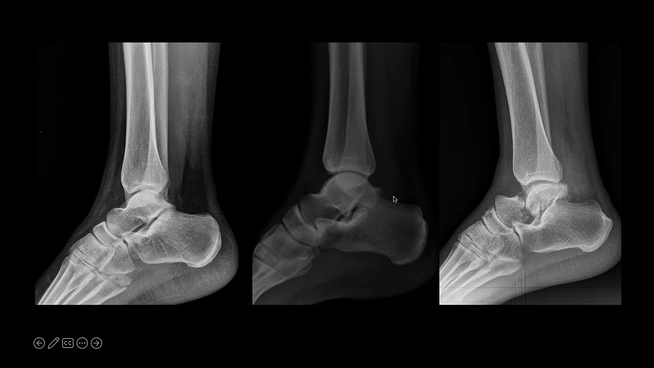Radiografia Lateral Normal Do Pe Anatomia Radiológica Da Extremidade