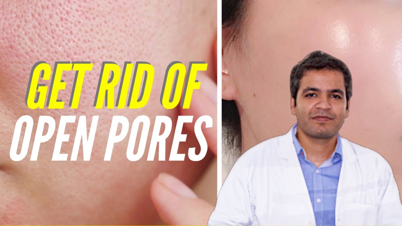 5 BEST Open Pores Treatments and Home Remedies To Get Rid of Large Open ...