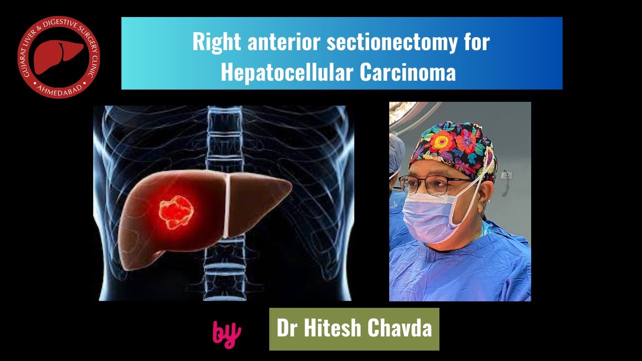 Right anterior sectionectomy for Hepatocellular Carcinoma | Liver ...