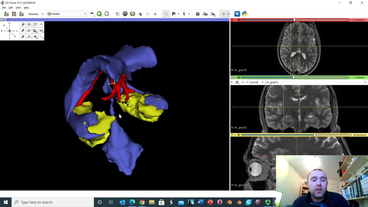 Limbic System Anatomy Mri