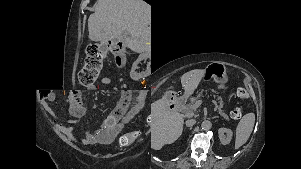 Cholecystoenteric fistula and gallstone small bowel obstruction - YouTube