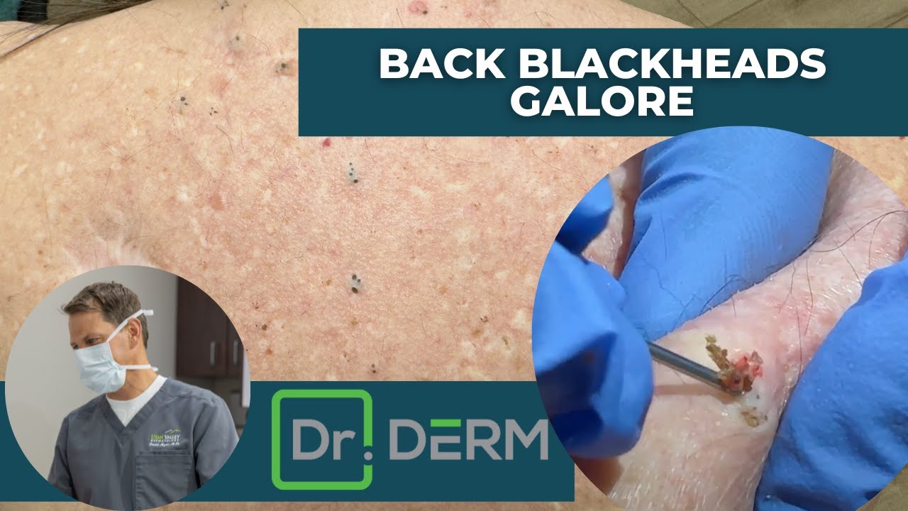 Back Blackheads Galore | Dr. Derm - YouTube