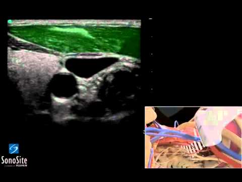 Guide 3D: Inserzione Ecoguidata di un catetere nella vena giugulare ...