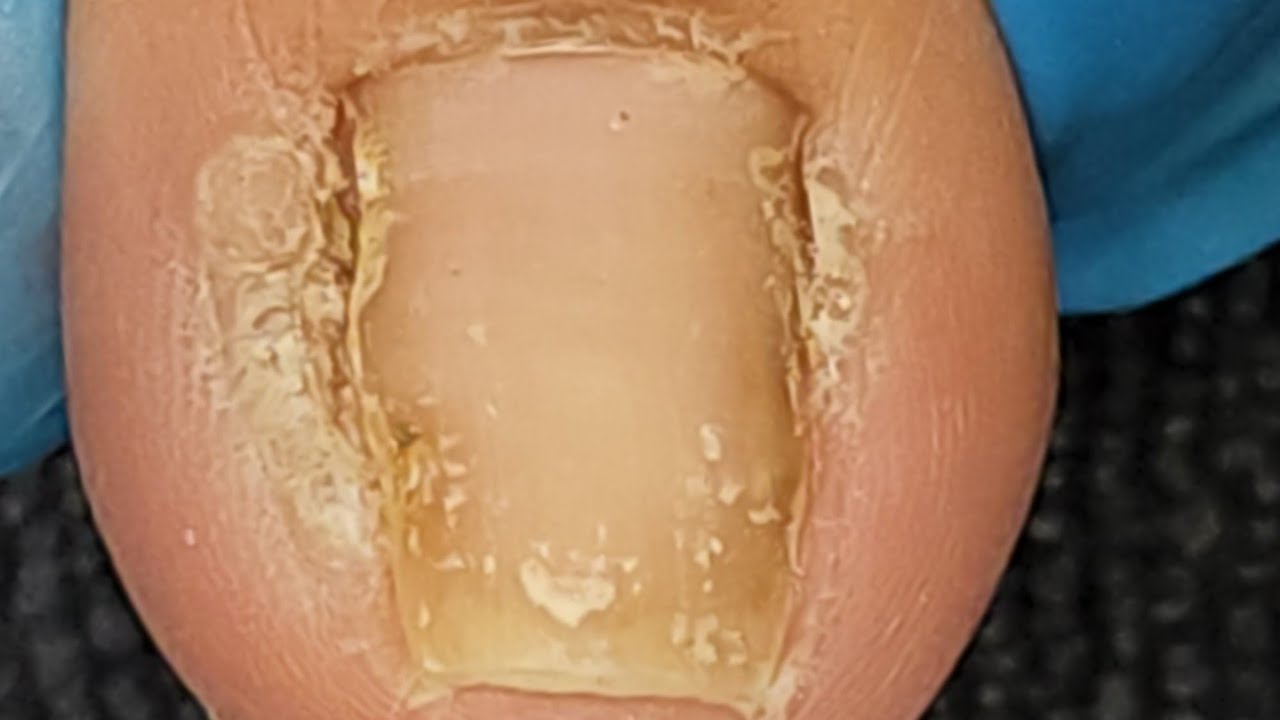 Kakatakot ang buong kuko dahil may warts o kalunggo - YouTube