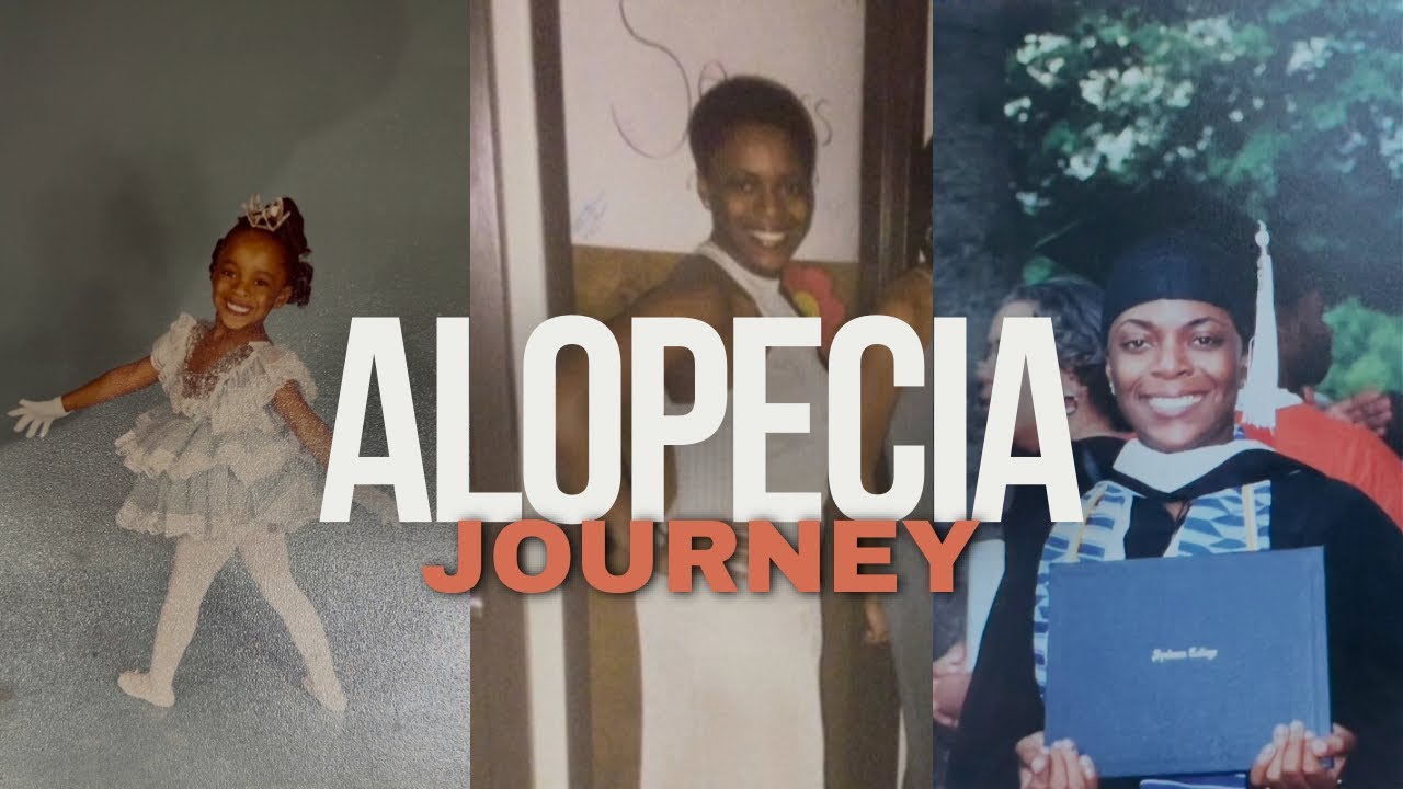 STORYTIME: I Am 44. I Have Alopecia. This Is My Journey. - YouTube