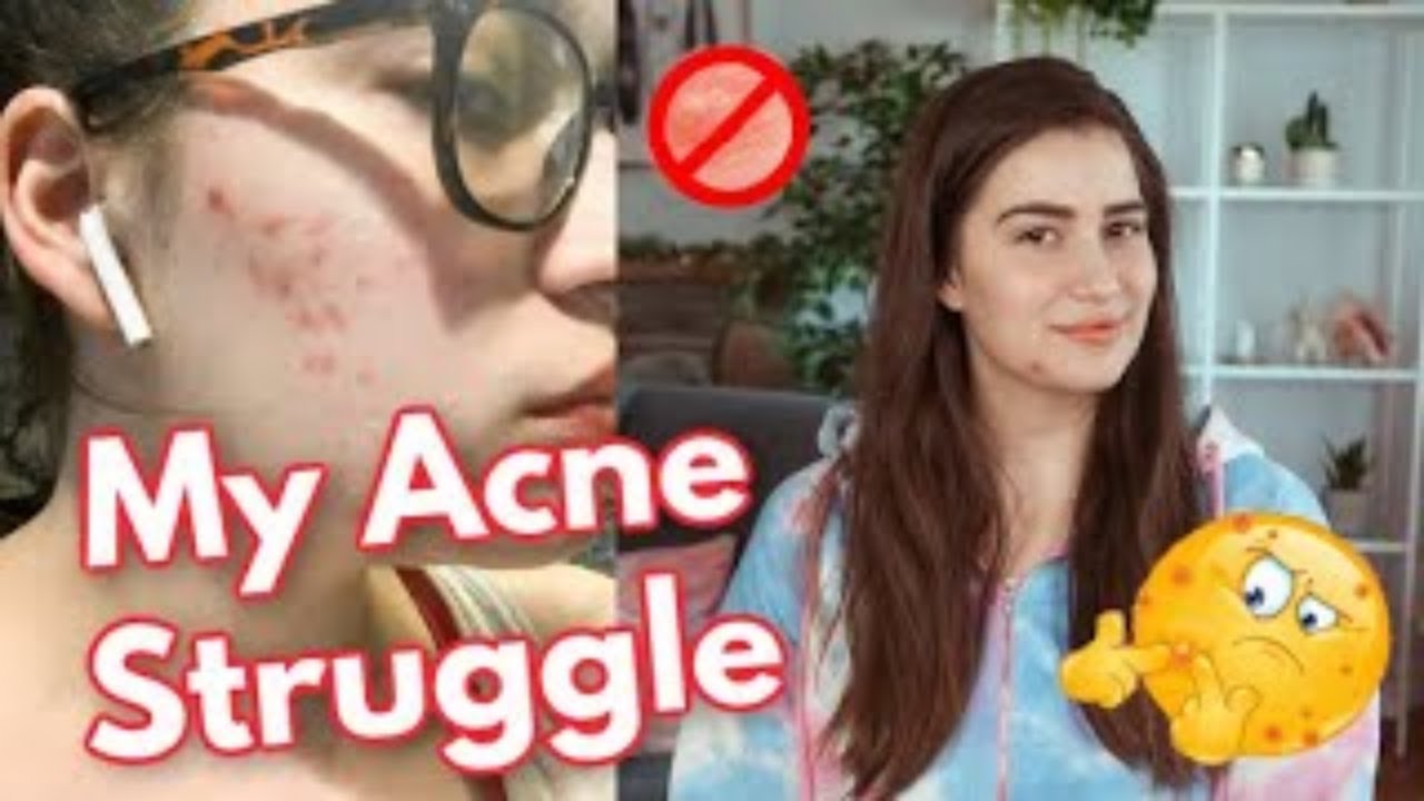 My Struggle With Acne And Self Confidence Youtube