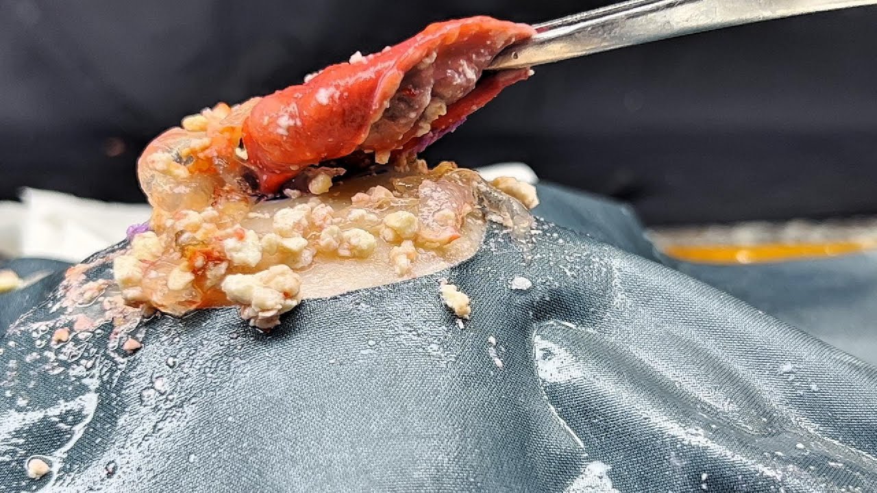 The TLC MrPopZit Enilsa Dr.Geoff Butler Dr.pimple 辥一刀 podologo.maurelio ...