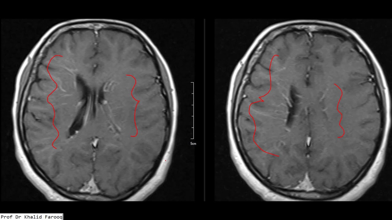 venous angiomas MRI brain - YouTube