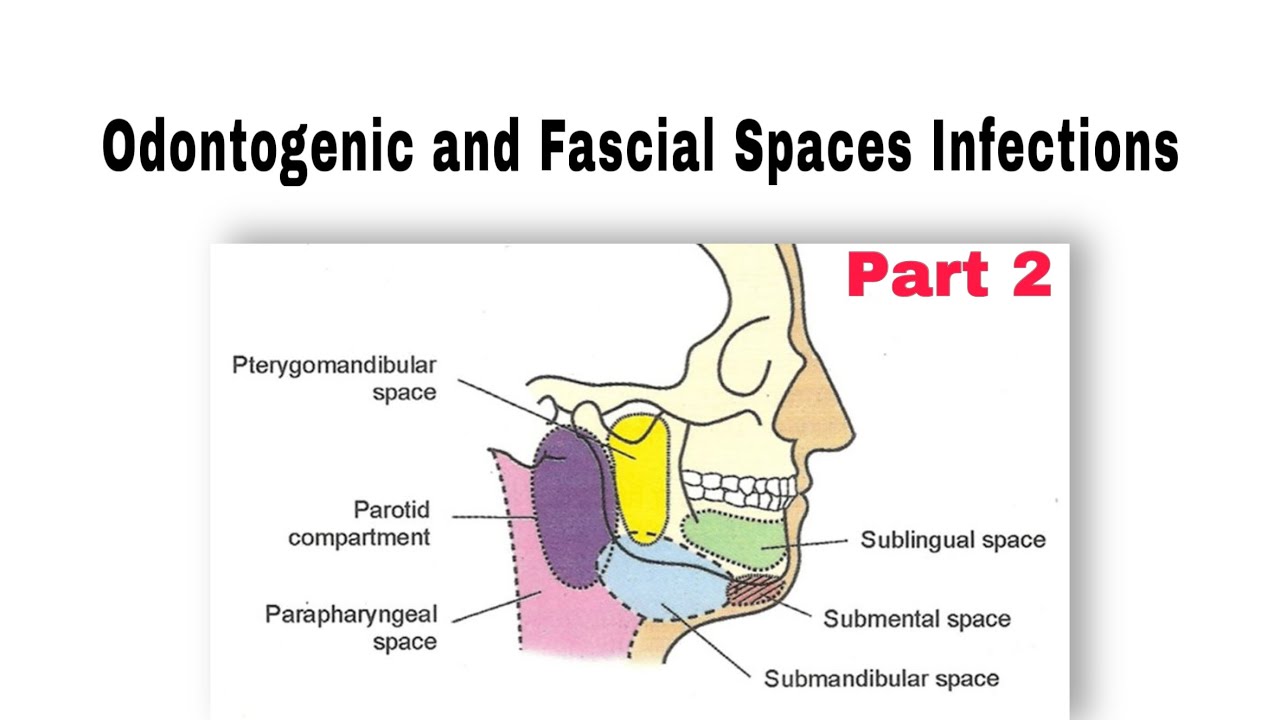 Odontogenic and Fascial Spaces Infections طب الأسنان مرحلة رابعة #oral ...