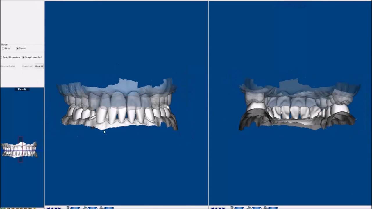 OMNIcam Ortho in Dolphin - YouTube