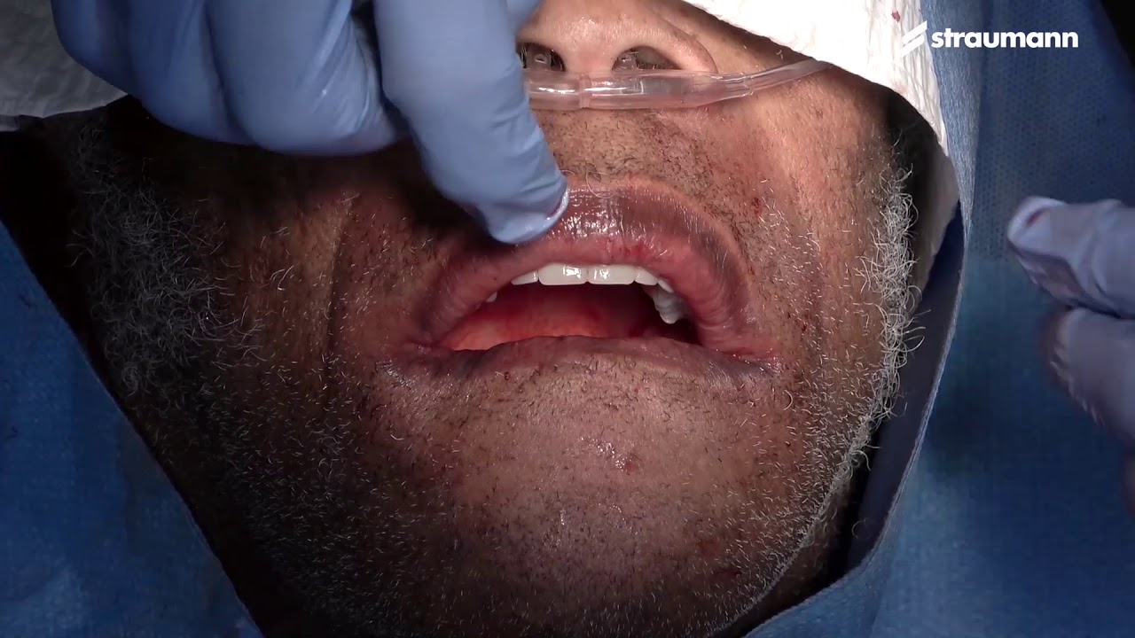 Straumann® Pro Arch BLX Surgical Video with Dr. Edmond Bedrossian - YouTube