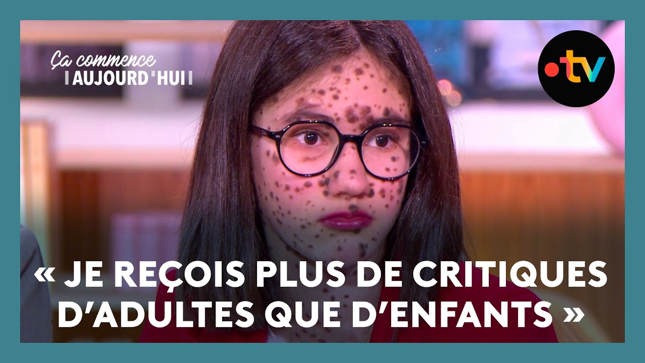 Alice est née avec un naevus géant congénital - Ça commence aujourd'hui ...