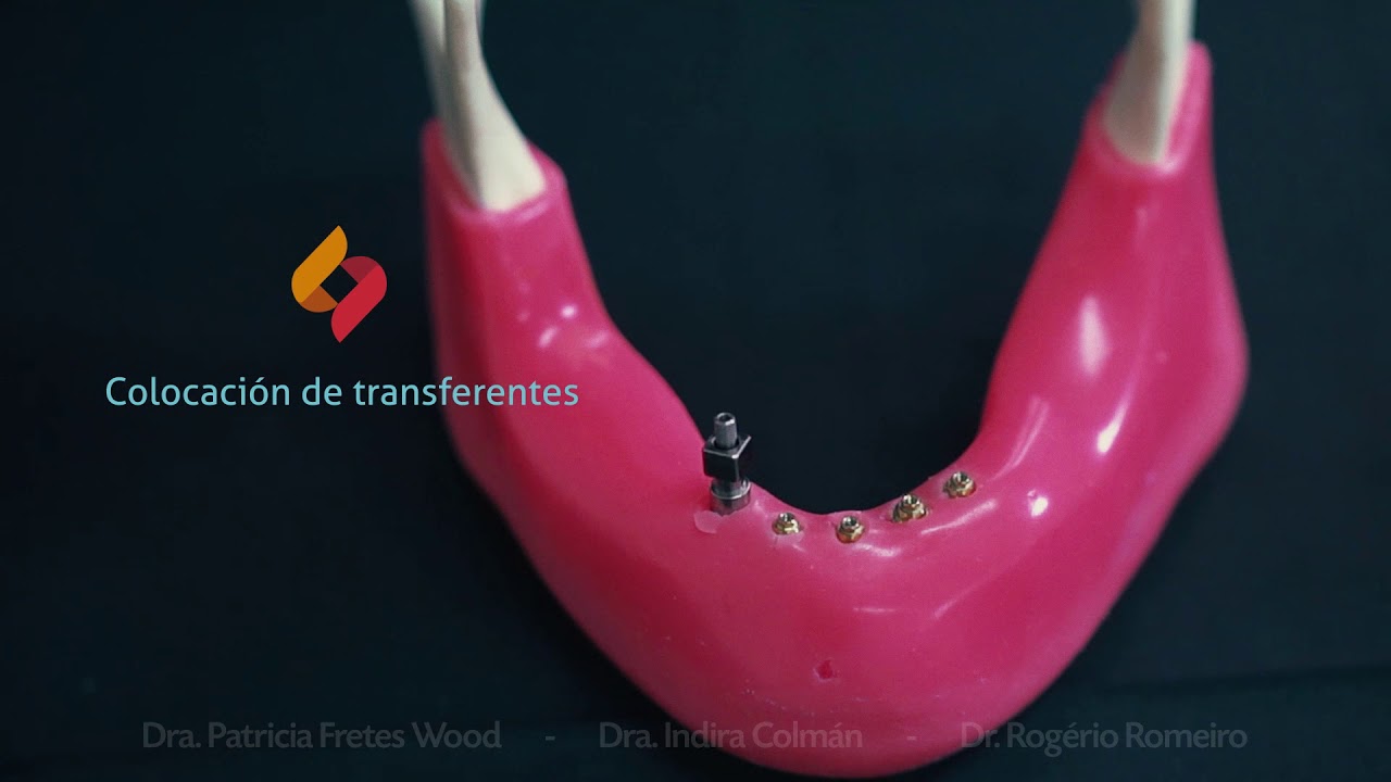 Prótesis tipo protocolo. Paso a paso. Hybrid Prosthesis. Step by step ...