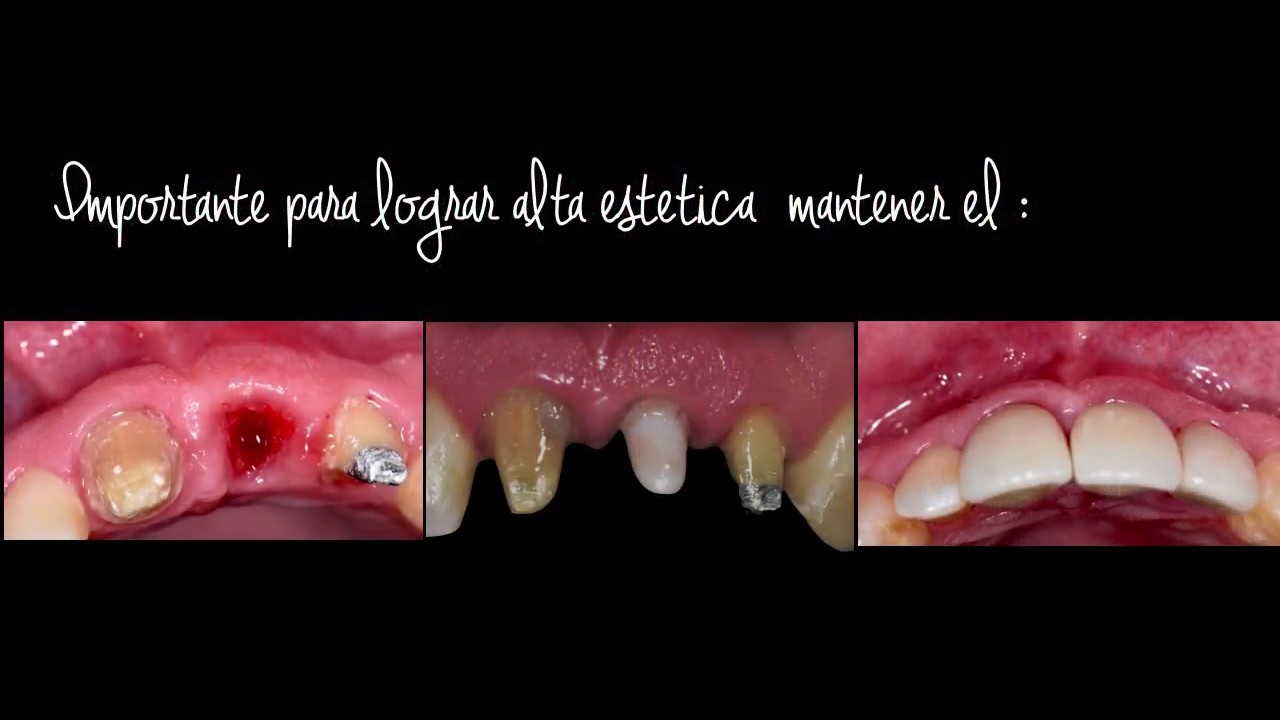 Implantes Dentales Panama Dr. Mario Chalhoub Implantologo Panamá - YouTube
