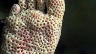 Trypophobia Definition