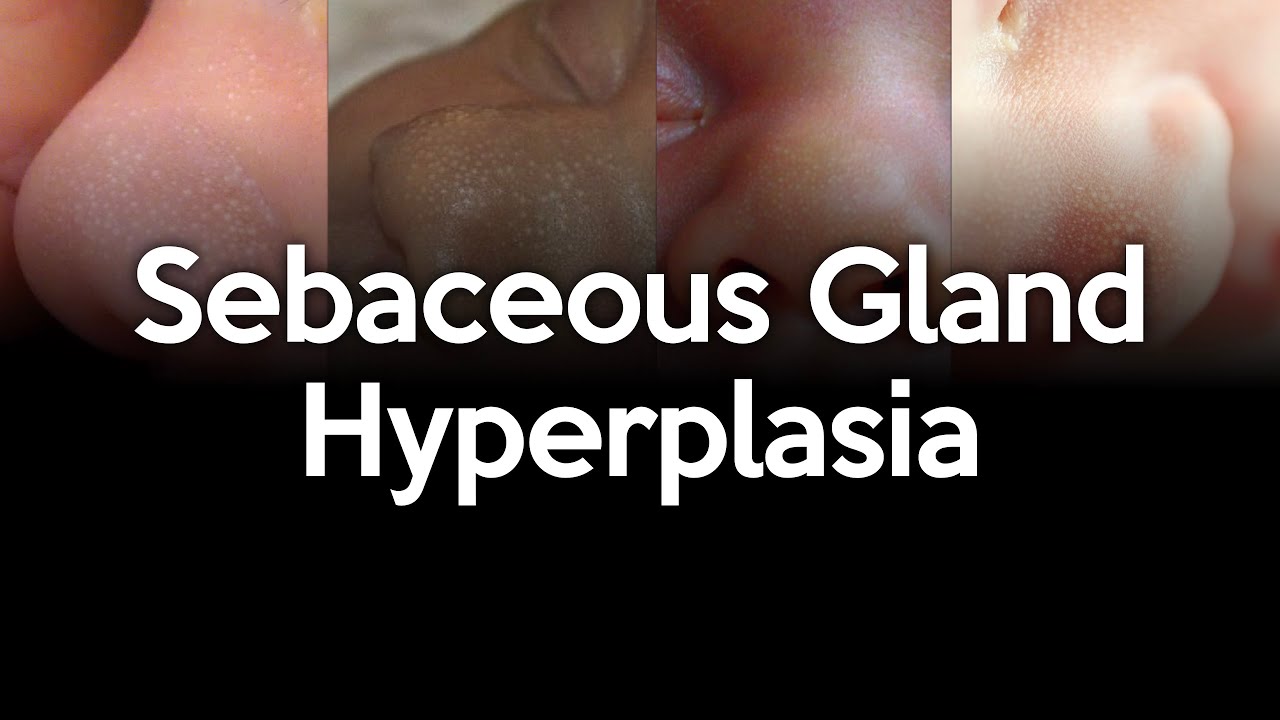 Sebaceous gland hyperplasia in the newborn - YouTube