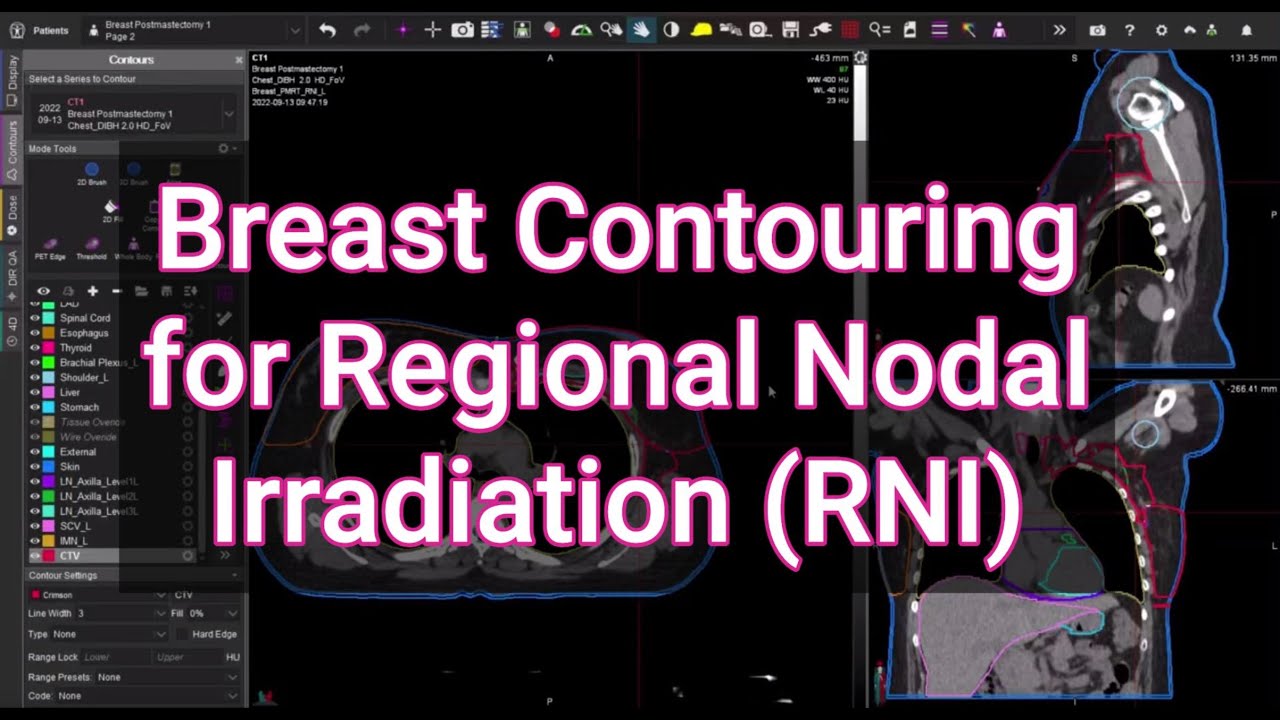 Breast Contouring Regional Nodes... a Walkthrough - YouTube