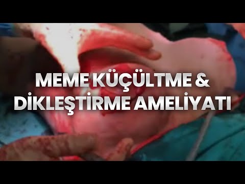 Meme Dikleştirme ve Küçültme Ameliyatı | Prof.  Dr.  Bekir Atik