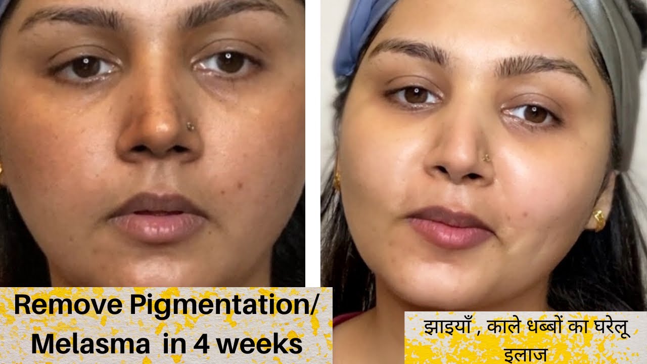 In just 4 weeks get rid of Pigmentation & Melasma / काले धब्बे / झाइयाँ ...