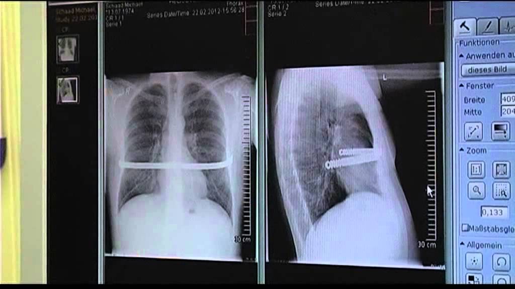 Trichterbrust Operation (pectus excavatum corrected with modified nuss procedure) - YouTube