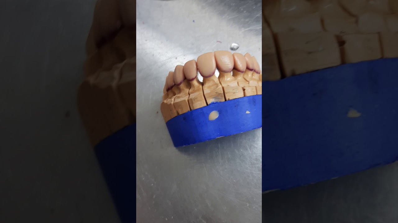 Wax emax veneers press Ep2 - YouTube