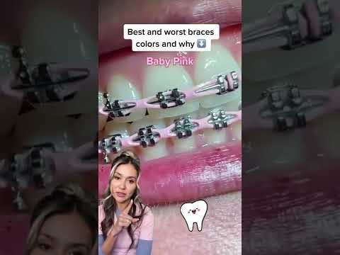 Are Light Pink Braces Good