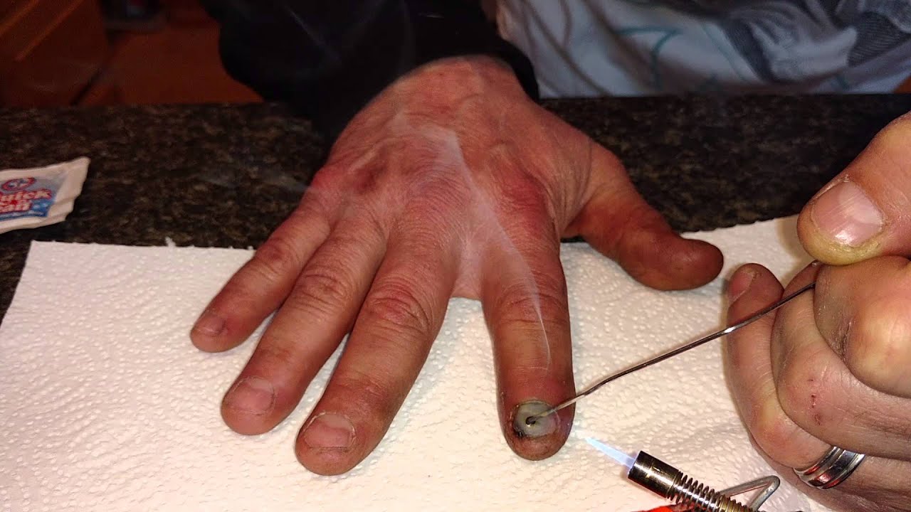 Fixing a smashed nail.. - YouTube