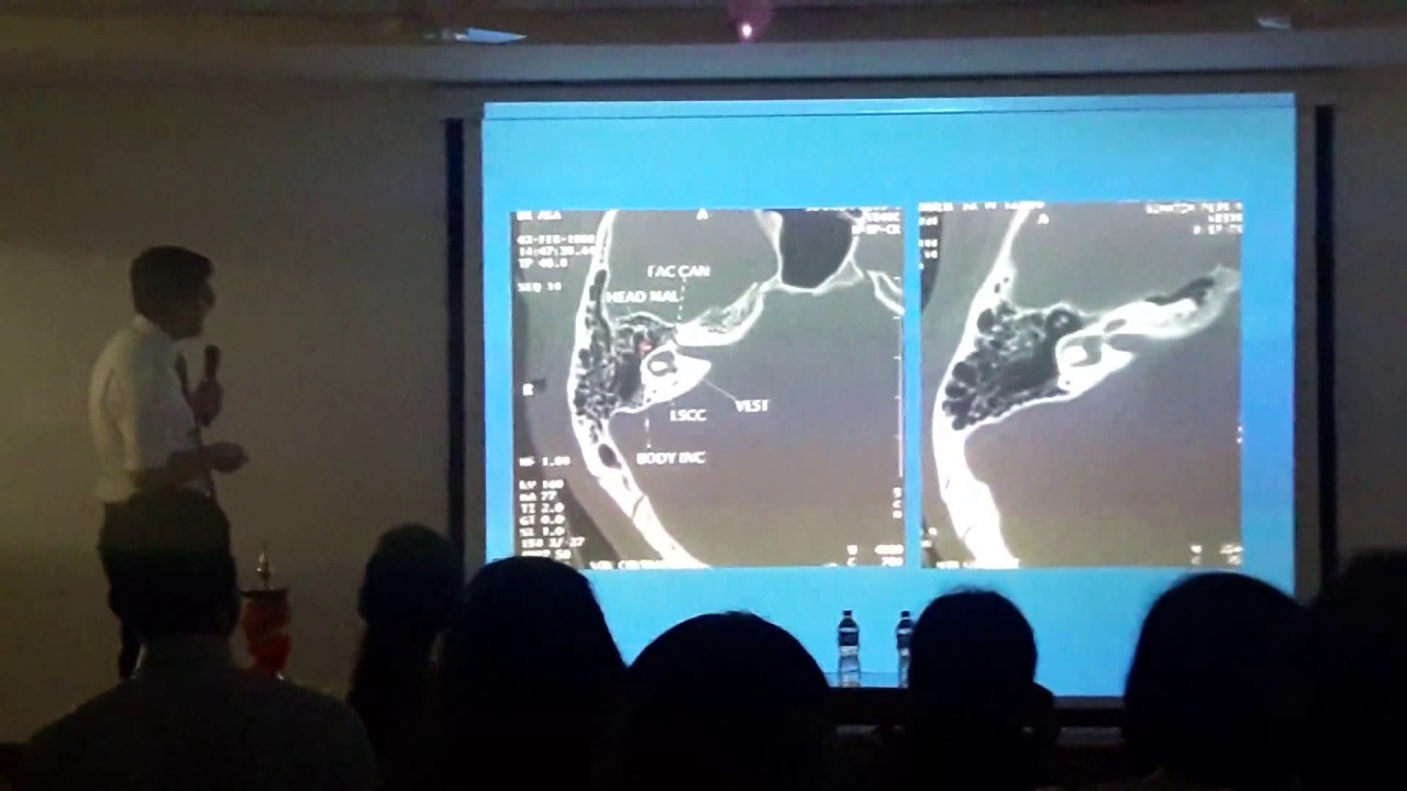 Radiology of Cochlear implant ( Video 3 ) - Dr. Sumit Mrig . . - YouTube