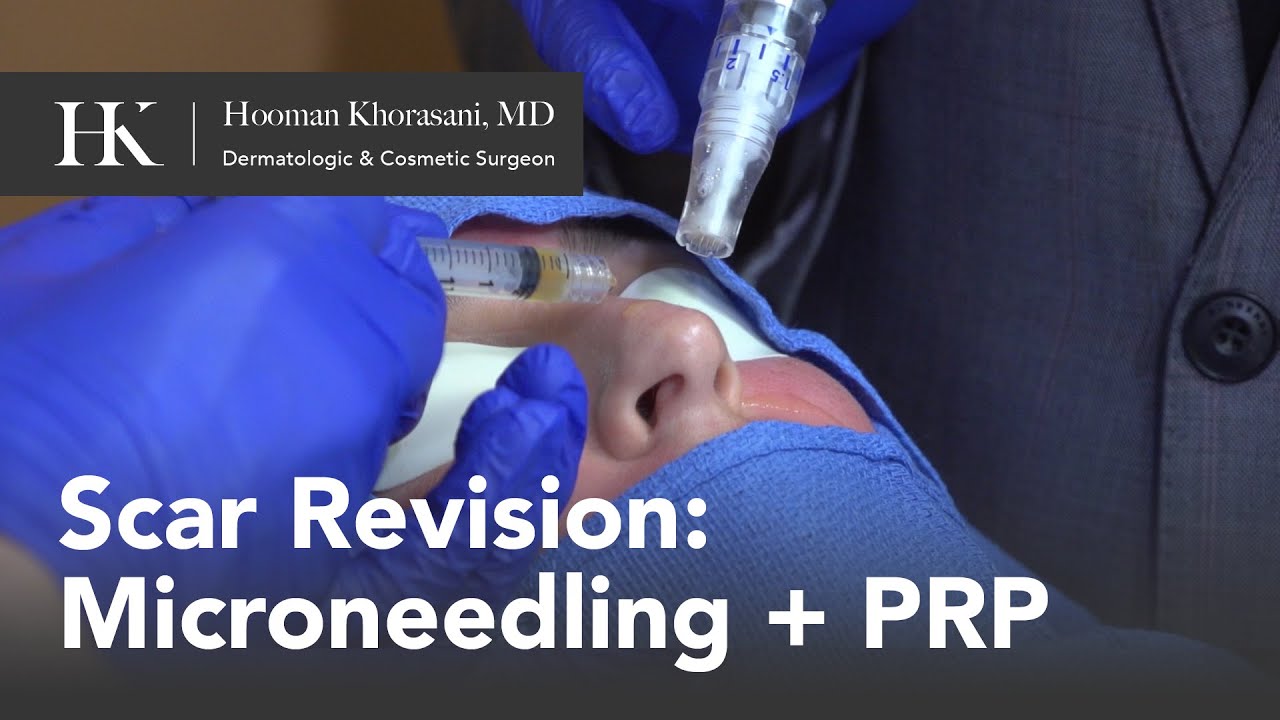 Scar Revision of the Nose using Microneedling Pen + Platelet-Rich ...