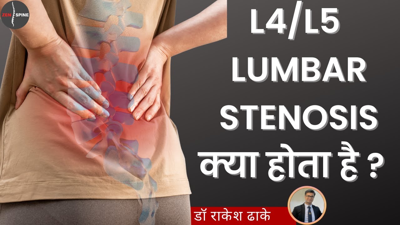 L4 / L5 Lumbar Stenosis (लंबर स्टेनोसिस) जानिए और समझिए | - YouTube