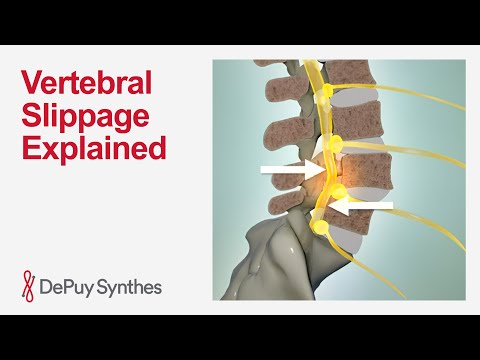 What Is Spondylolisthesis? Causes, Symptoms & Treatment Options | DePuy Synthes