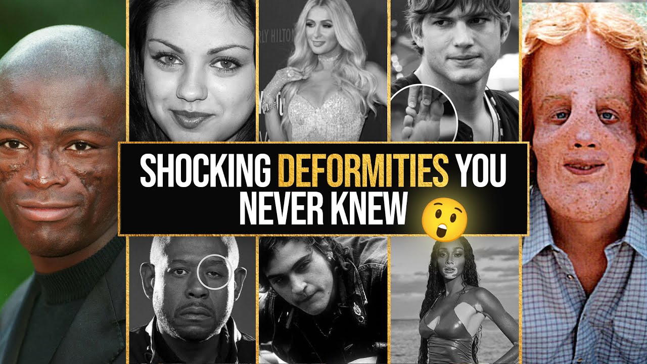 20 Celebrities with Weird body deformities You can't imagine 😲 Then and ...