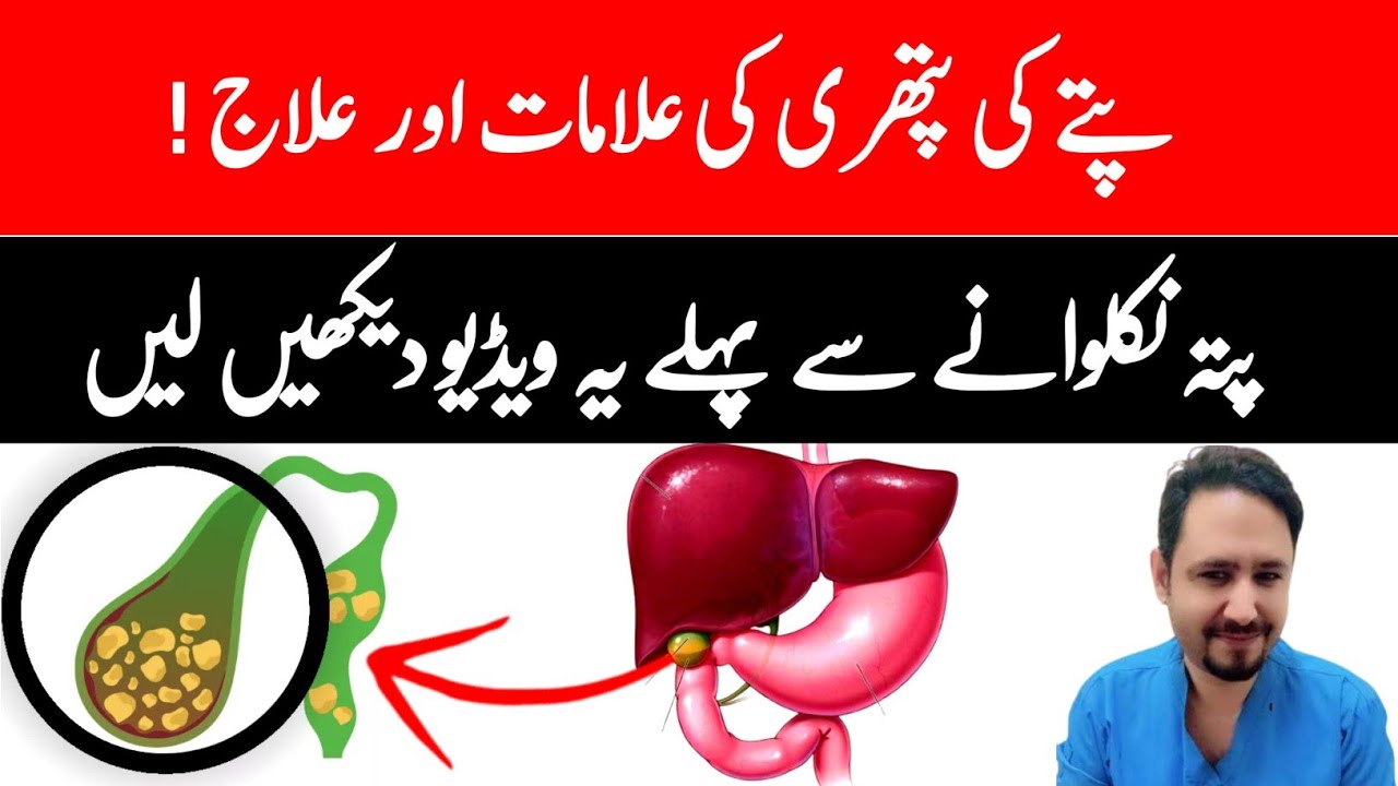Gallbladder Stones - Bile Salt In Urdu Hindi - Dr Irfan - YouTube