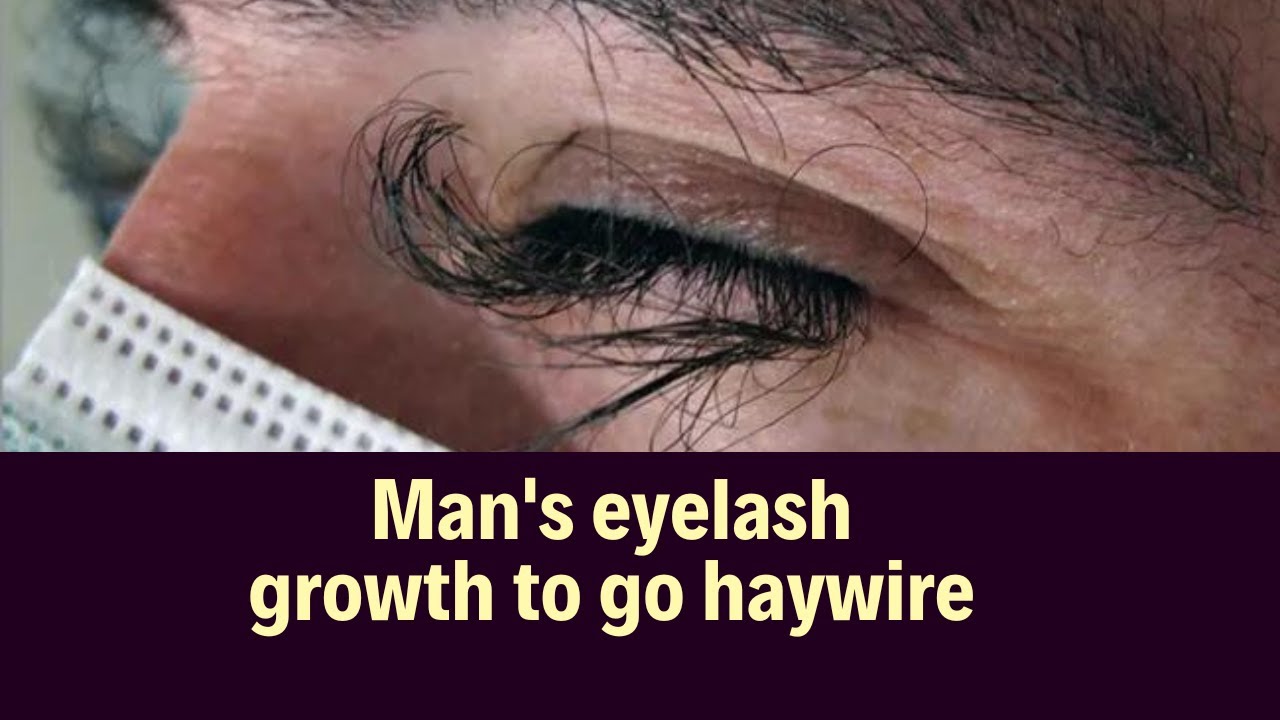 Man's Eyelash growth to go Haywire!? - YouTube
