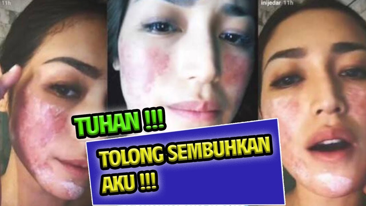 FULL Penjelasan JEDAR Soal Tragedi Muka Merah dan Perih - YouTube
