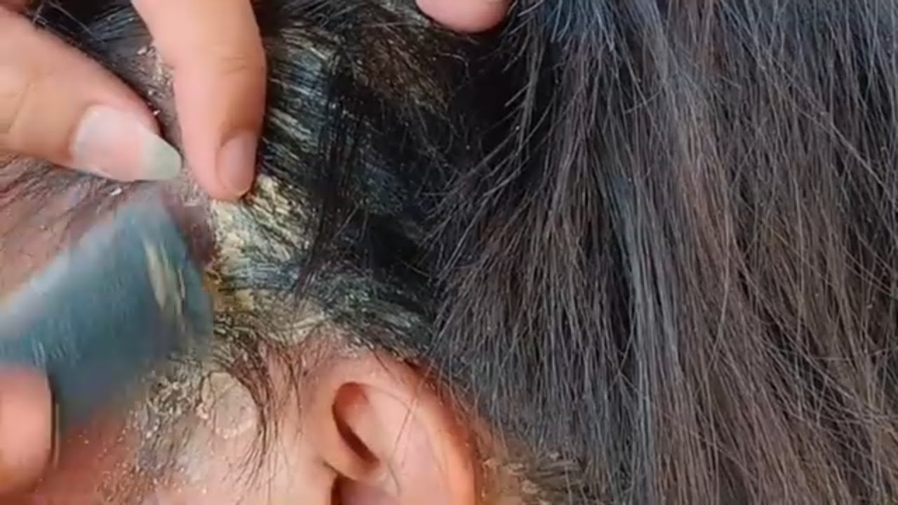 ASMR Scalp Scratching for Sleep and Relaxing Care #696 - YouTube