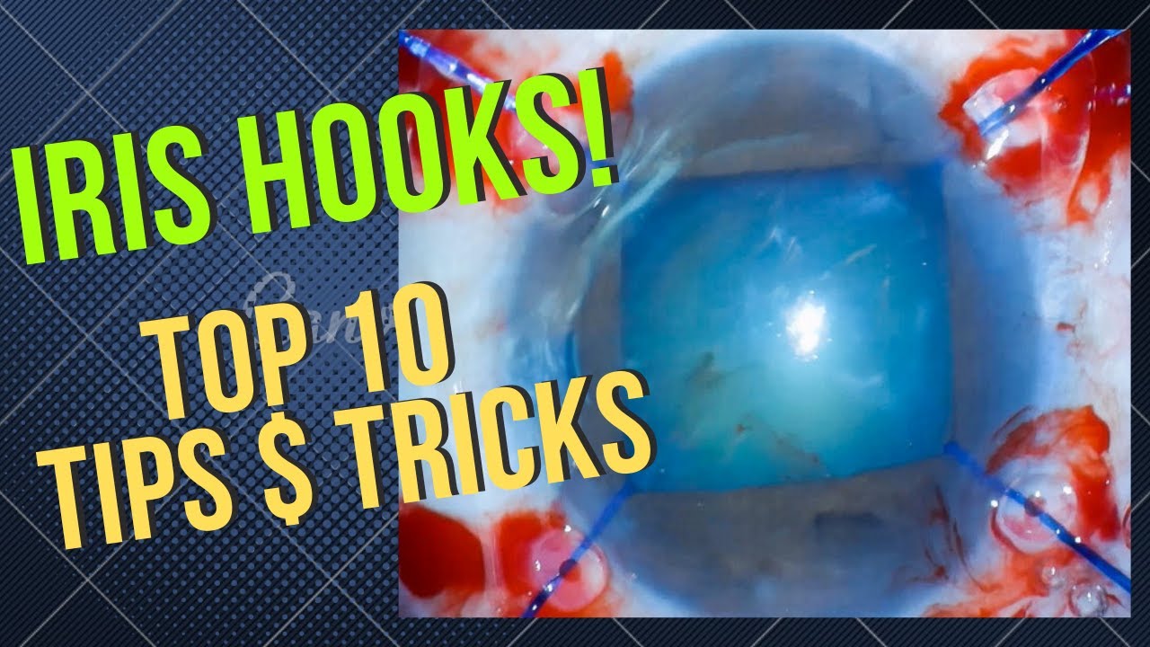 case series 15. Iris Hooks in a small non dilating pupil, top 10 tips and tricks, phaco cataract ...