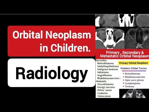 ORBITAL NEOPLASM in Children -Differential Diagnosis -Imaging ...