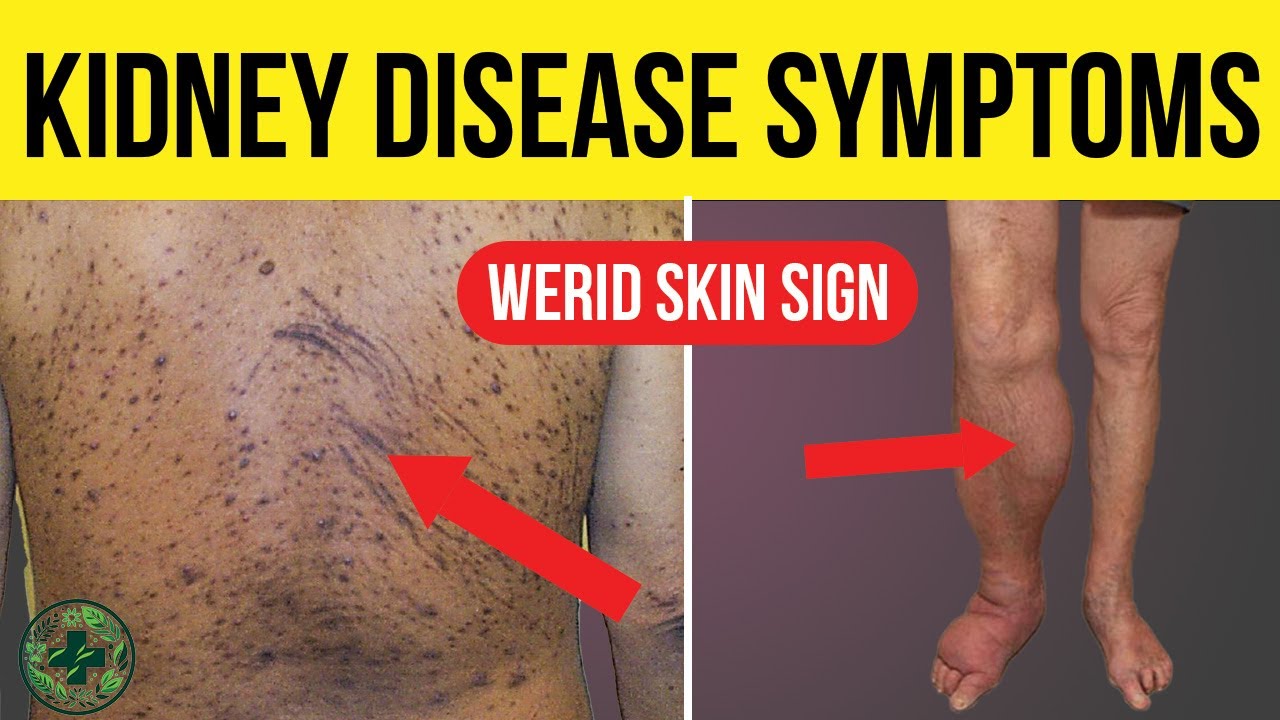 Skin signs of Kidney Disease | Kidney Disease Symptoms | Kidney Failure ...