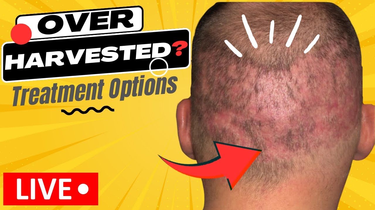 Hair Transplant in India | Repair of Overharvested Donor - YouTube
