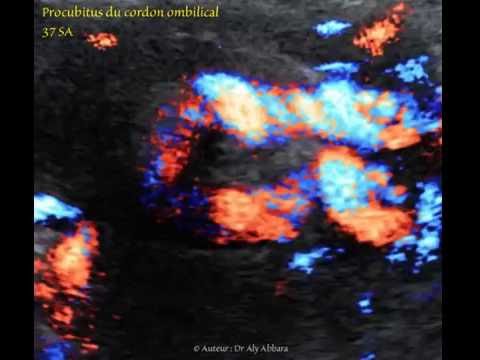 Procubitus du cordon ombilical 37 SA - YouTube