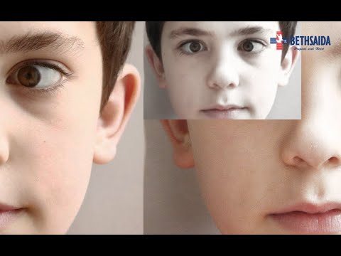 #YukPahami PENYEBAB DAN CARA MENGATASI STRABISMUS ATAU MATA JULING