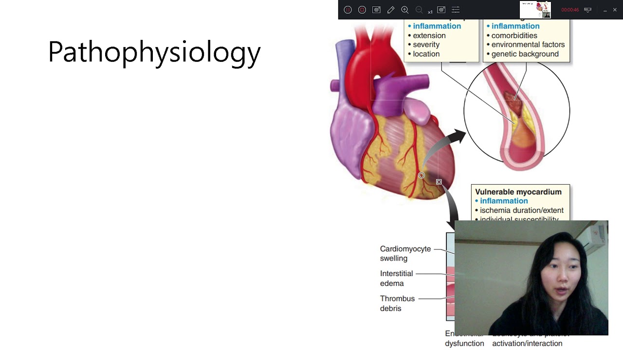 2020 8조 ACS pathophysiology by 강지연 - YouTube