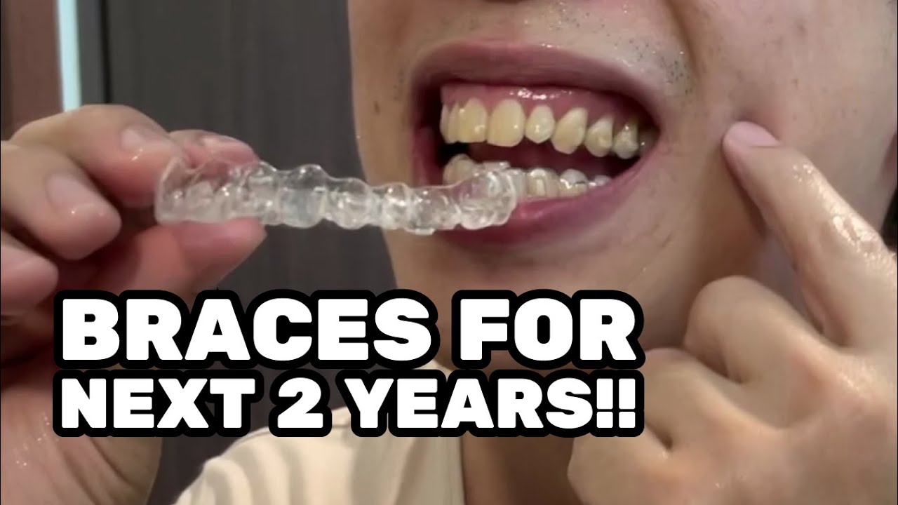 Got my 1st Invisalign aligners, and how it feels to be wearing - YouTube