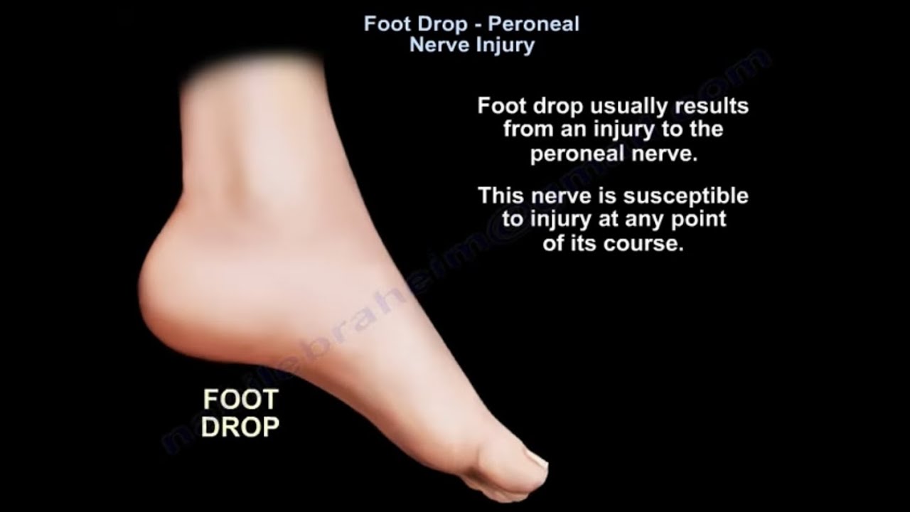 Foot Drop Peroneal Nerve Injury YouTube