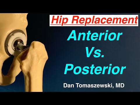 How Is Posterior Hip Replacement Done